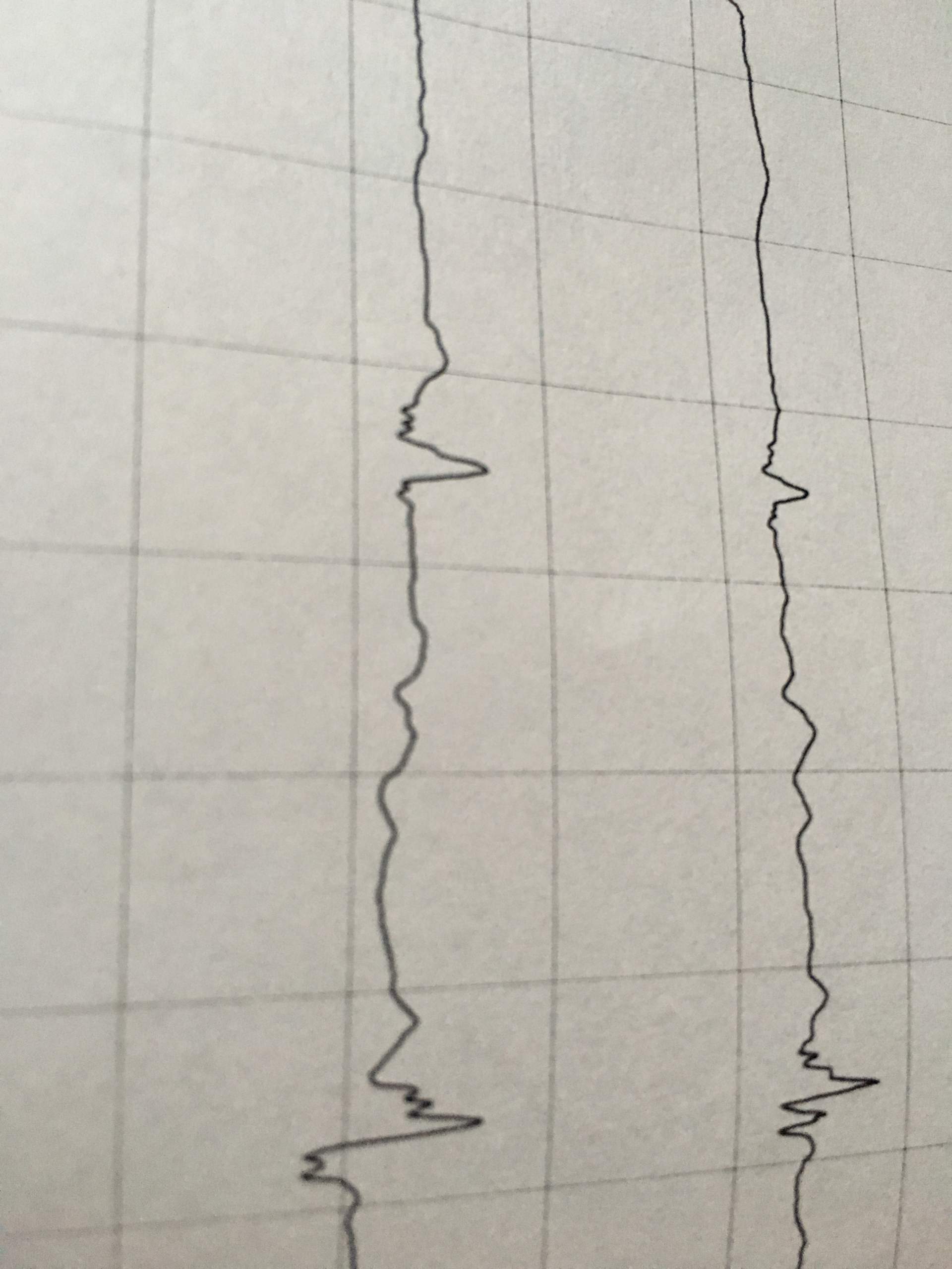 Was sind das für Zacken im ekg? (Gesundheit, Arzt, Krankheit)