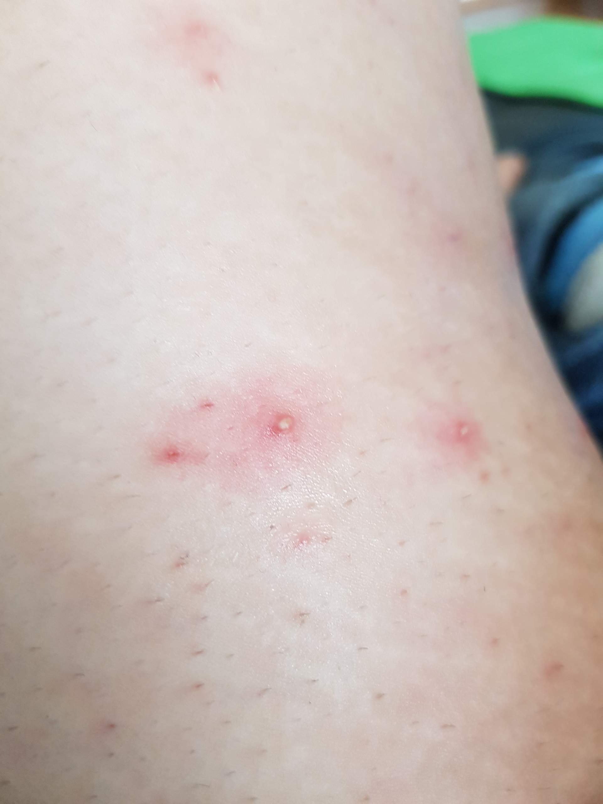 Was sind dass für pickel? (Beine)