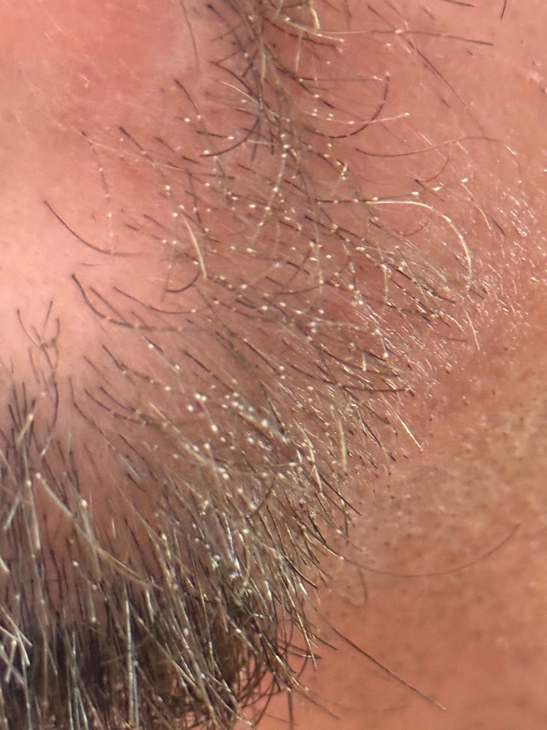 Was sind diese weissen Punkte in meinem Bart? (Haare, Dermatologie ...