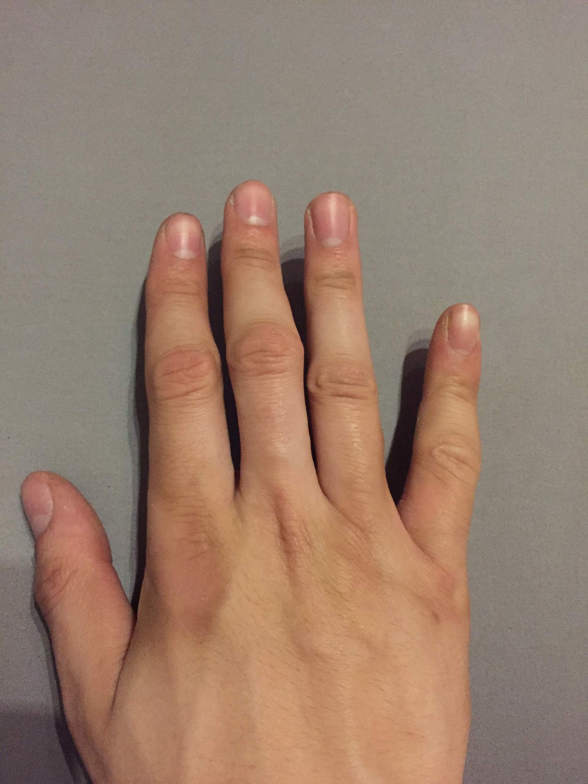 Was tun gegen krumme Finger? (Gesundheit, Medizin)