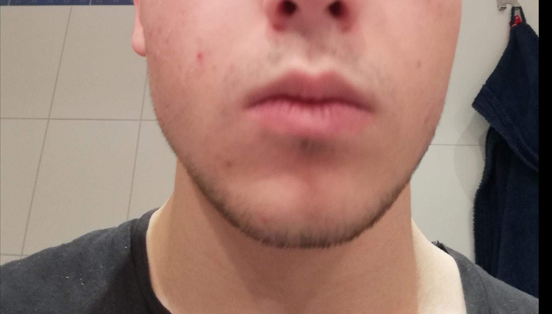 Weg oder lassen? (Bartwuchs, Barthaare)