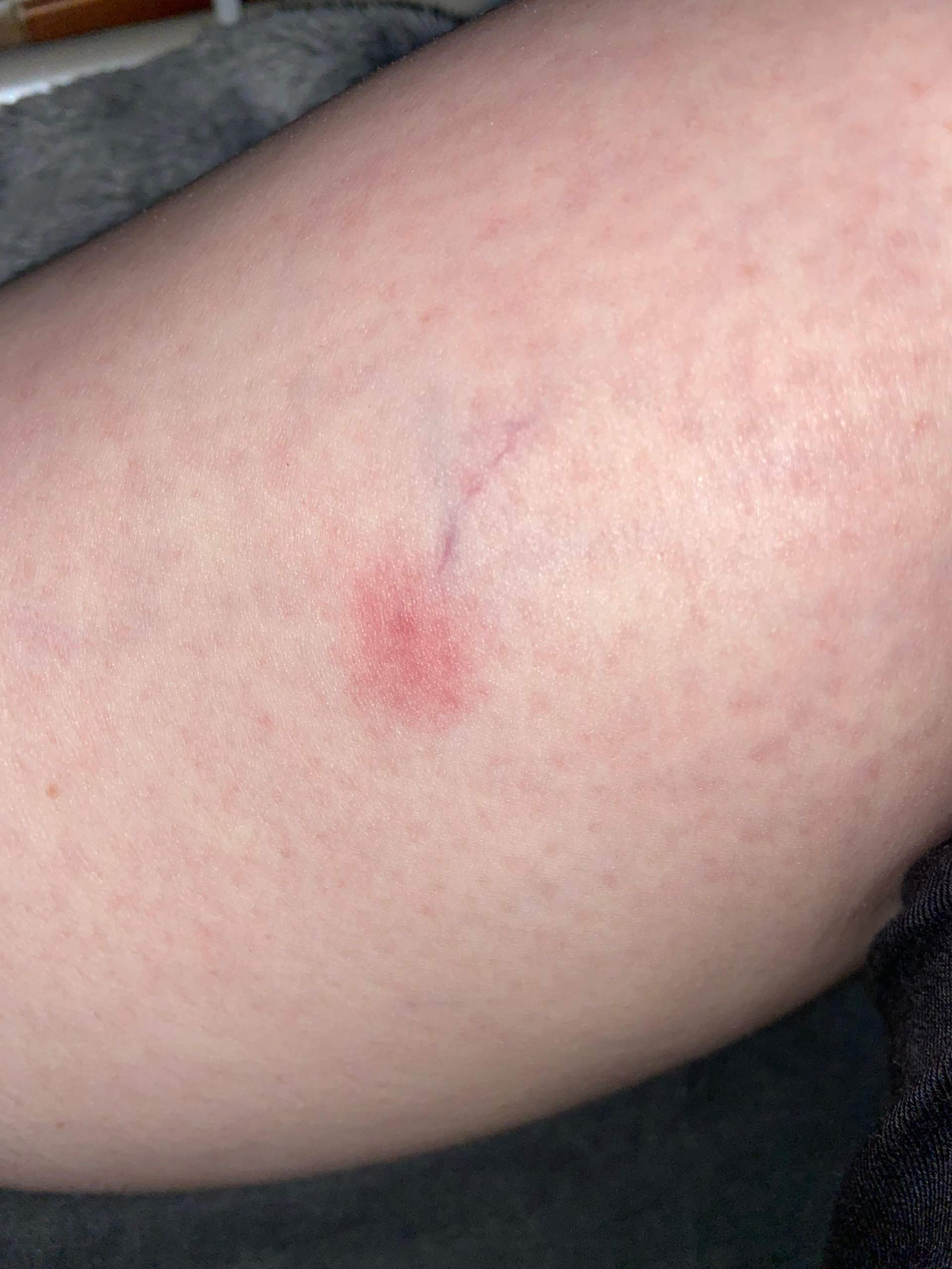 Weiß einer wo auf einmal der rote Fleck herkommt? (Gesundheit und ...