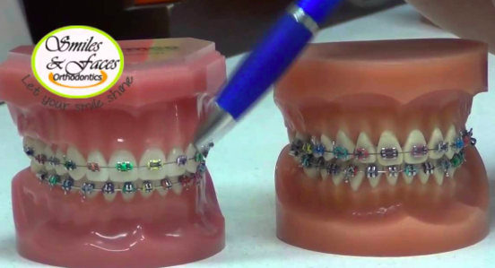 Welche Brackets sind besser normal oder mini (Bild)? (Gesundheit und ...