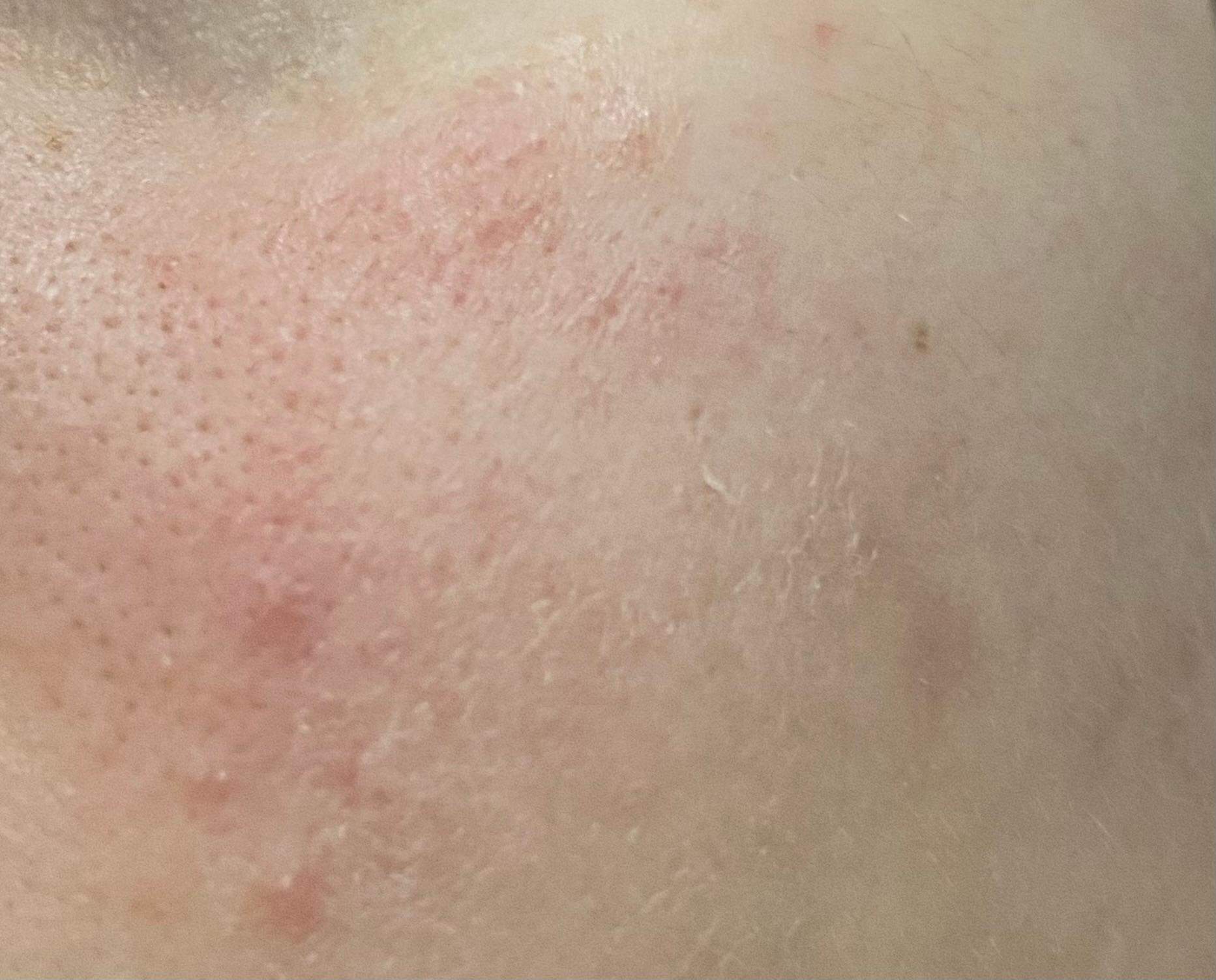 Welche skin care für fettige Haut? (Mädchen, Pflege, Pickel)