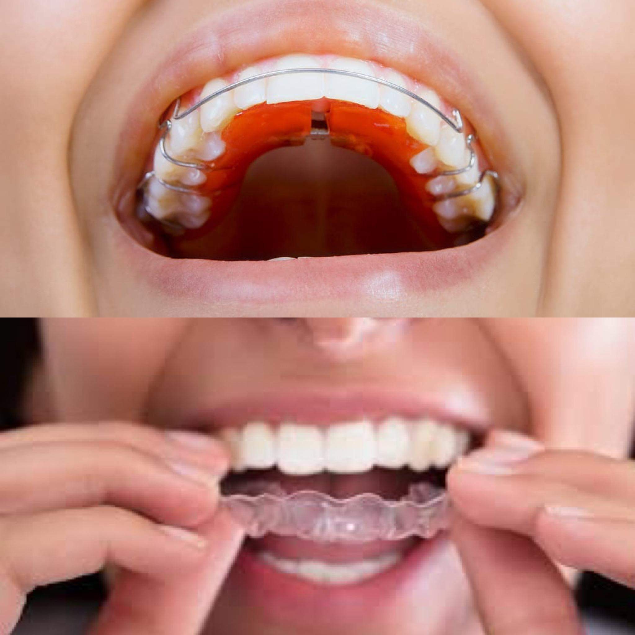 Retainer Kieferorthopädie Kosten – KGLCCG
