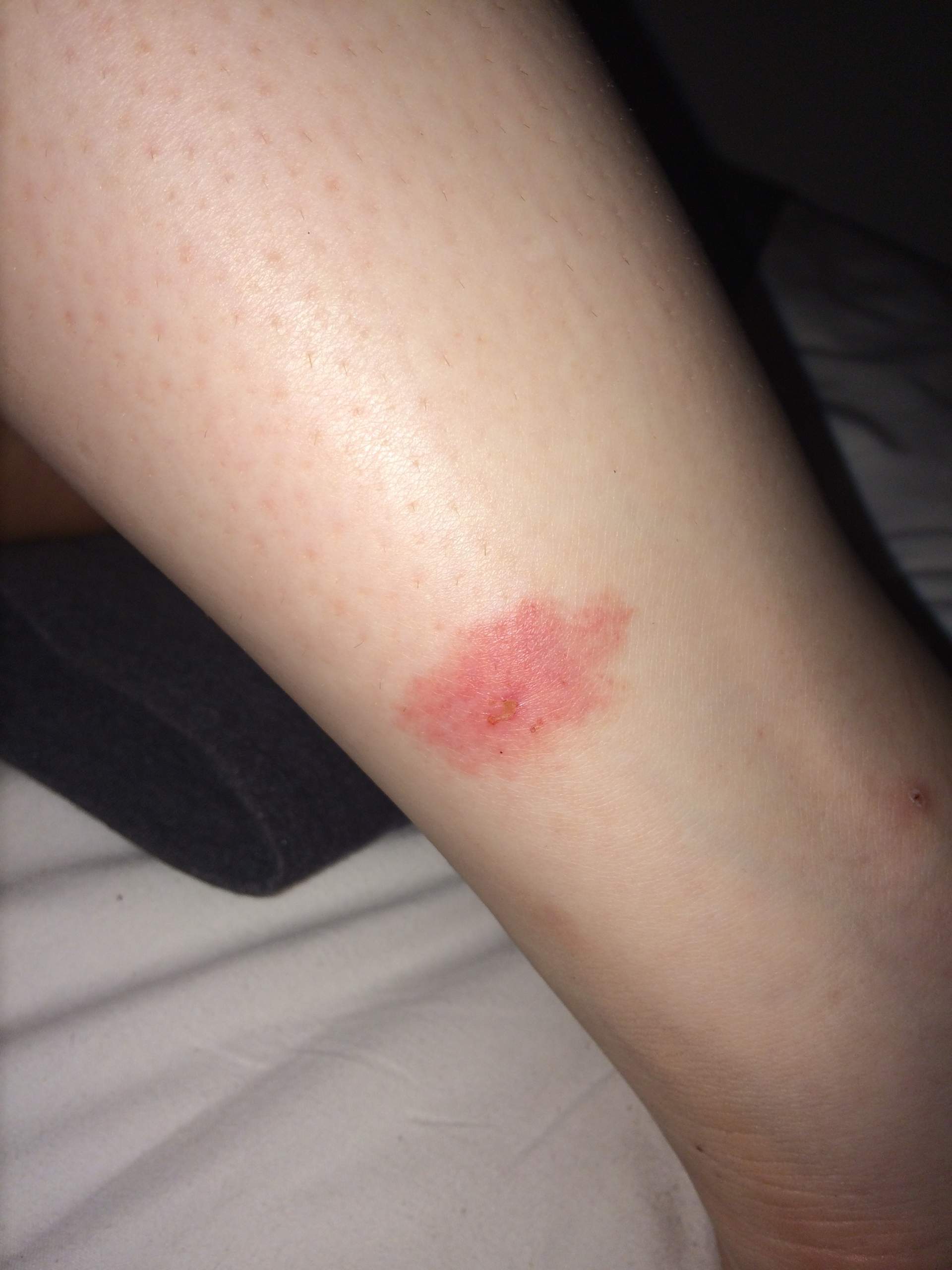 Was für ein Stich oder für eine allergische Reaktion ist das ... Was für ein Stich oder für eine allergische Reaktion ist das ...