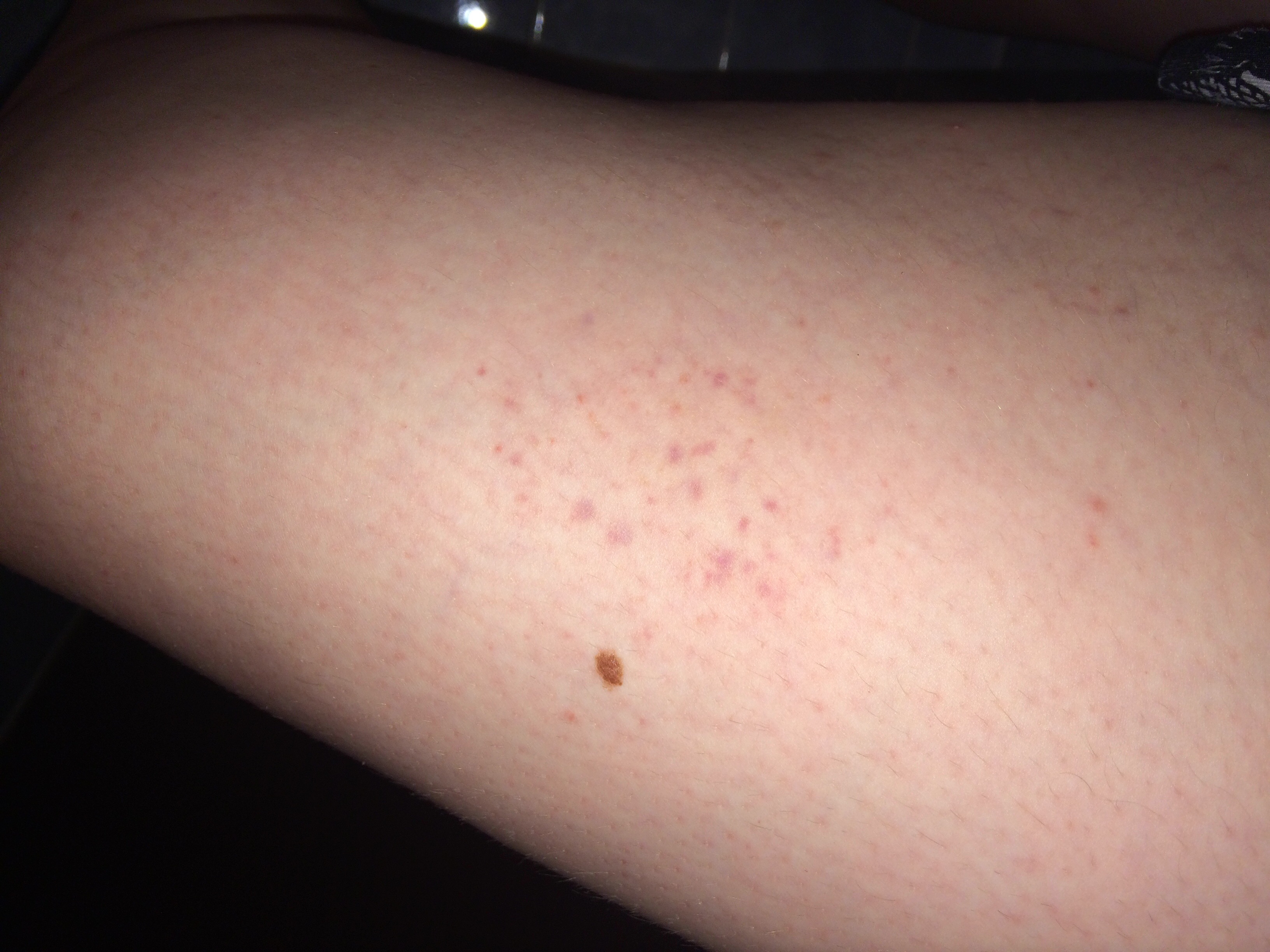 Was für ein Stich oder für eine allergische Reaktion ist das ... Was für ein Stich oder für eine allergische Reaktion ist das ...