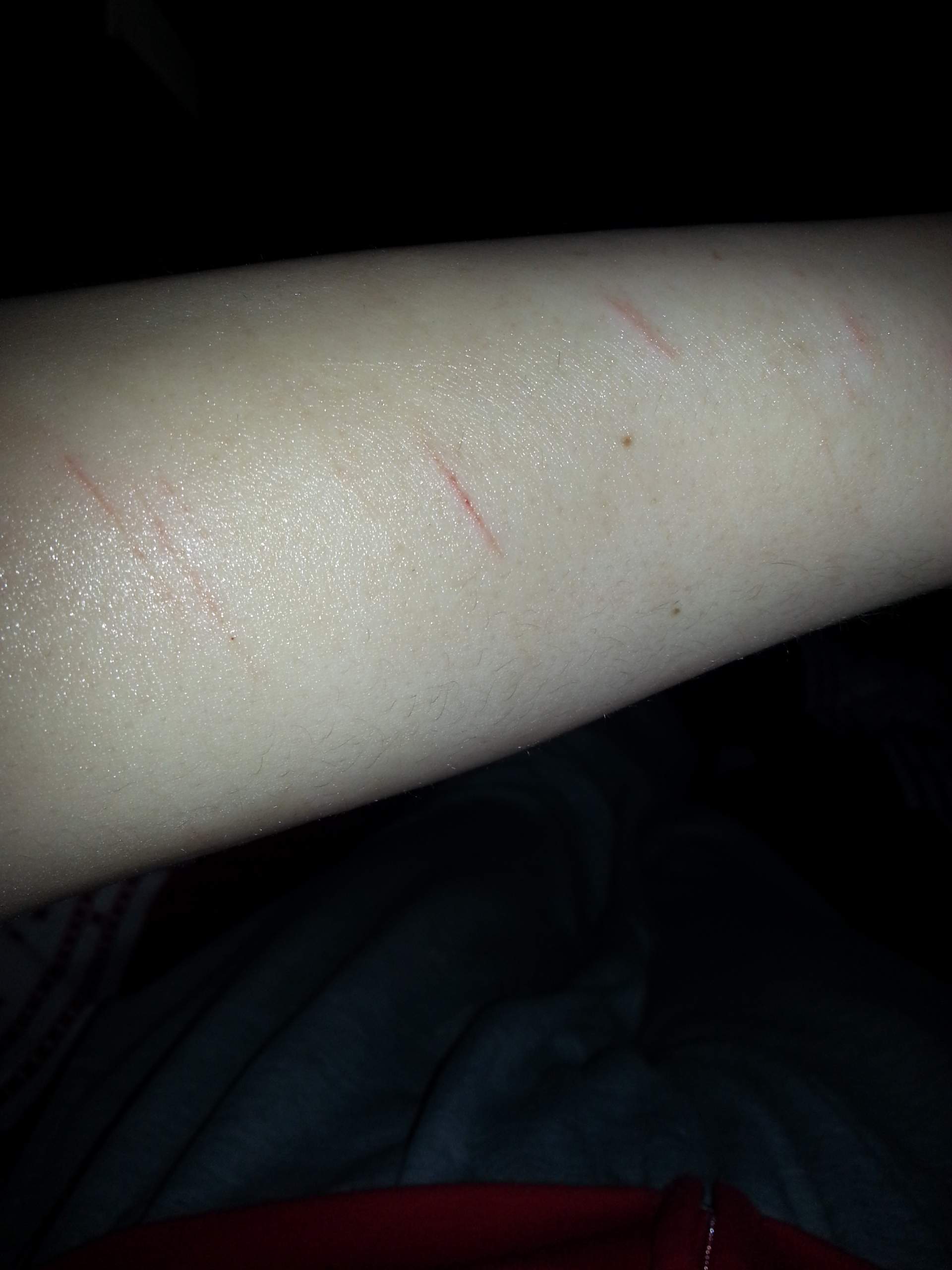 werden das narben? :'( (Arm)