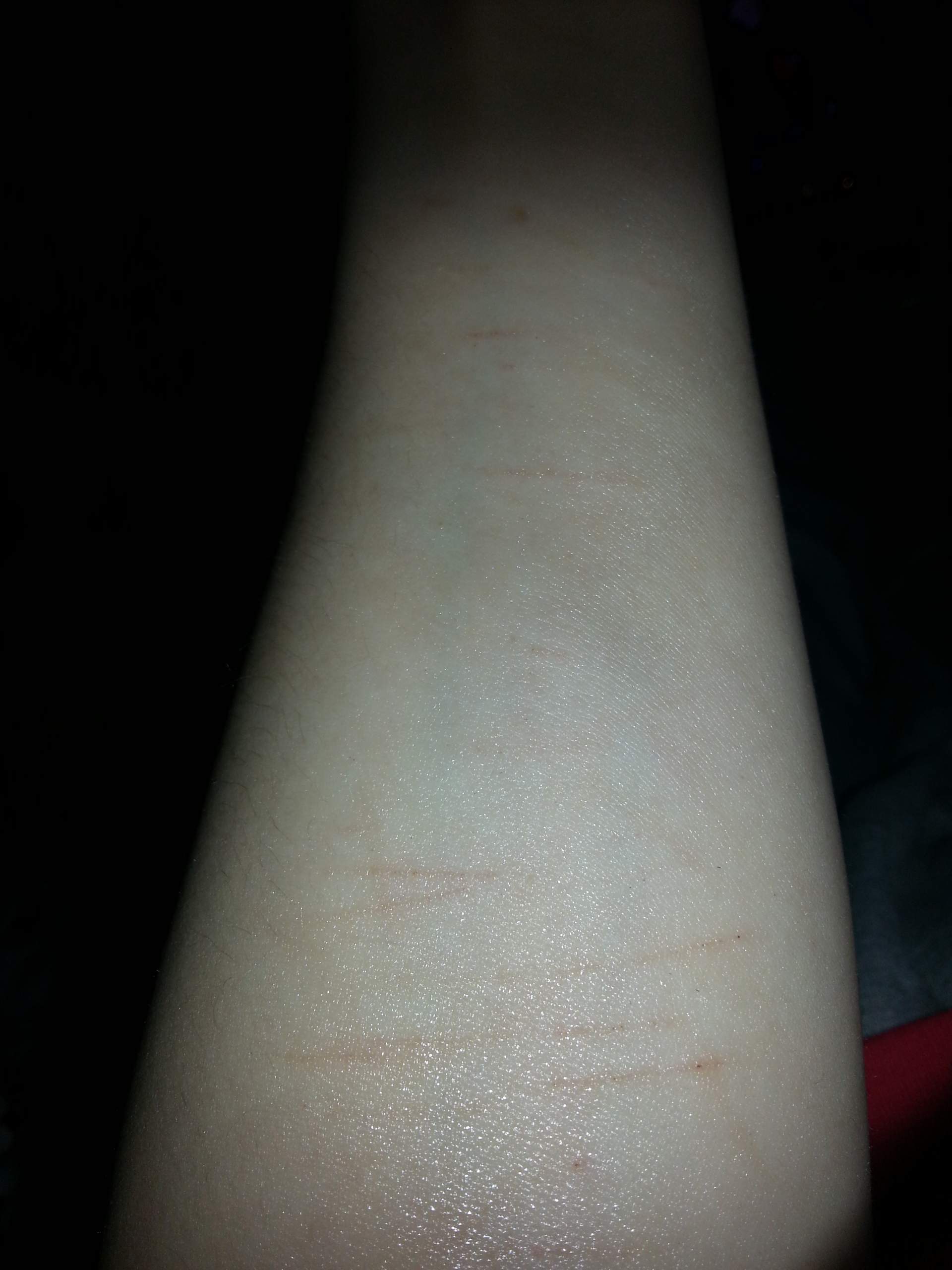 werden das narben? :'( (Arm)
