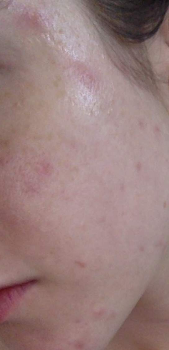 Wie bekämpfe ich schnell und effektiv diese Pickel, Pickelmale und ...