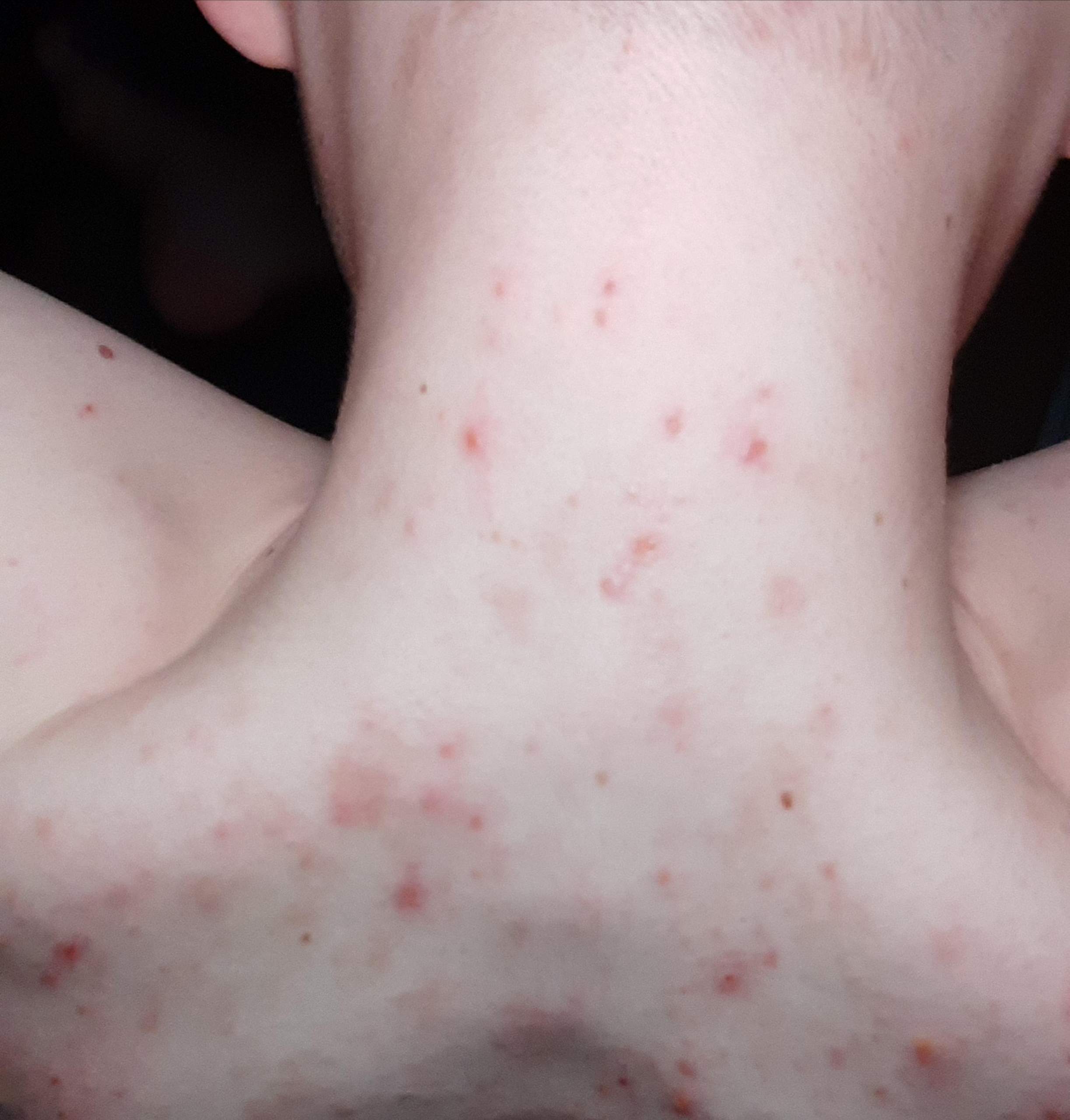 Wie bekomme ich Pickel am Nacken und oberen Rücken weg? (Körper, Pflege ...