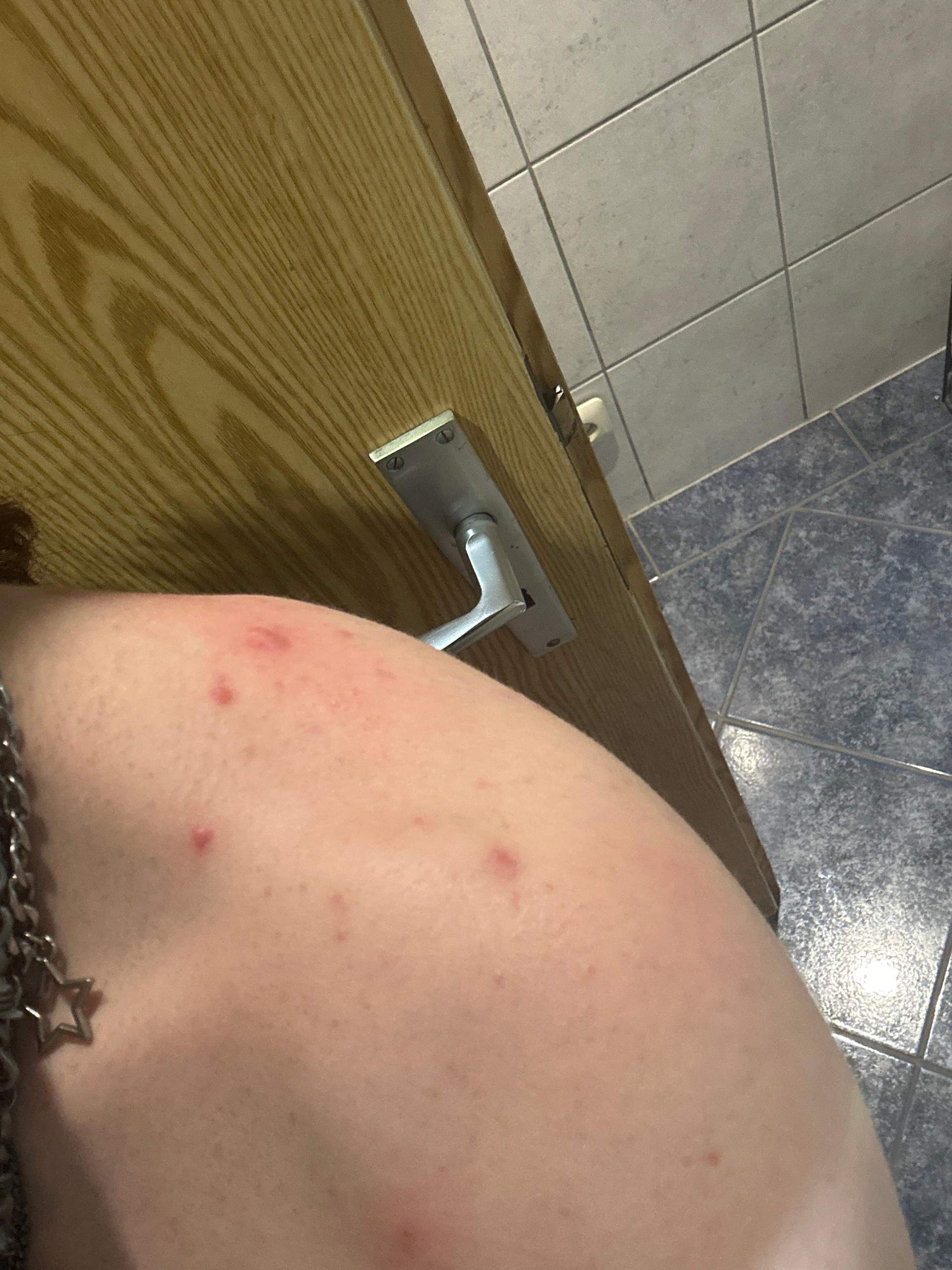 Wie bekommt man Pickel am Rücken/Schulterbereich weg? (Körper, Haut ...