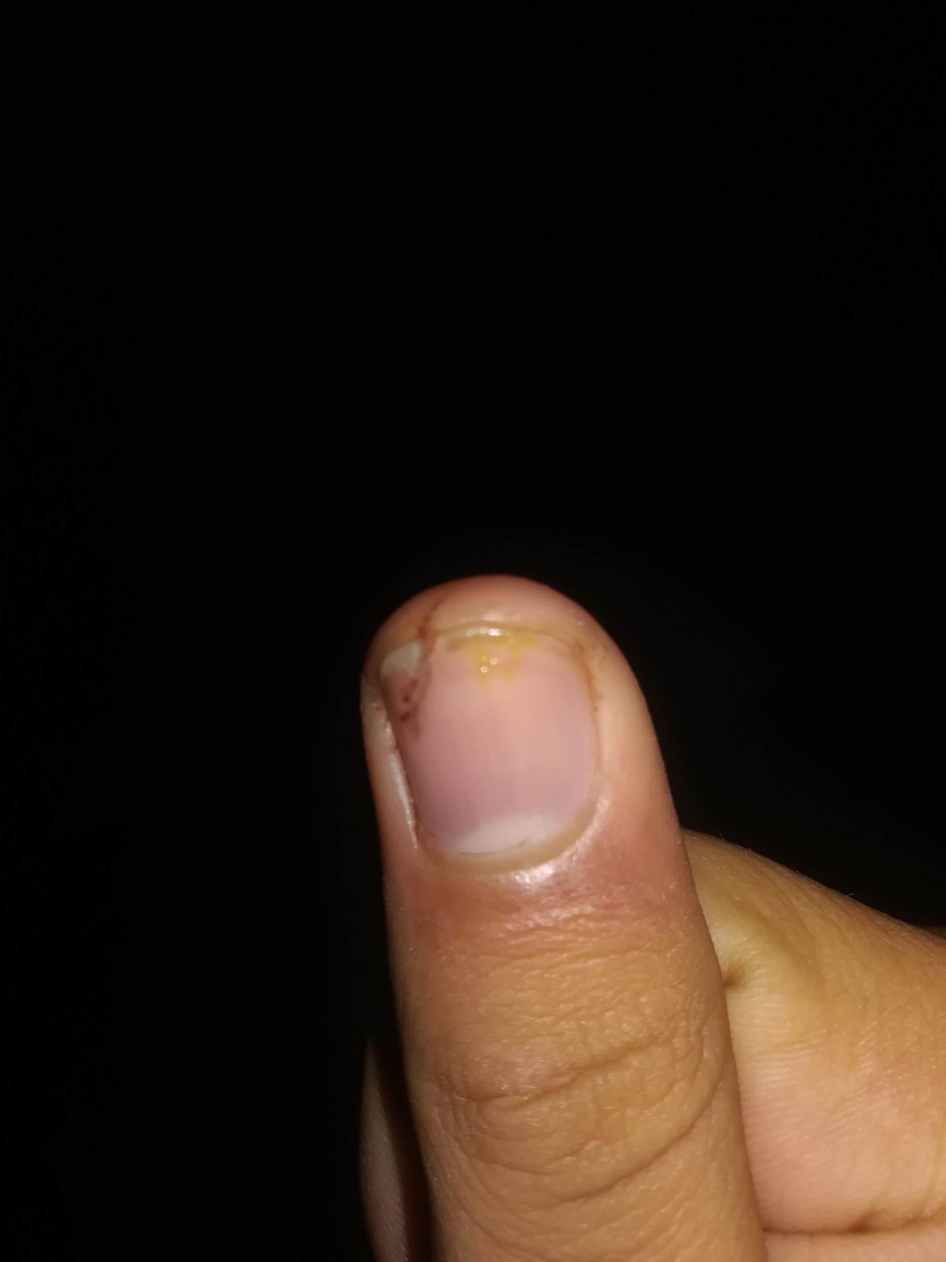 Wie kann ich den eingerissenen Nagel reparieren? (Gesundheit und ...