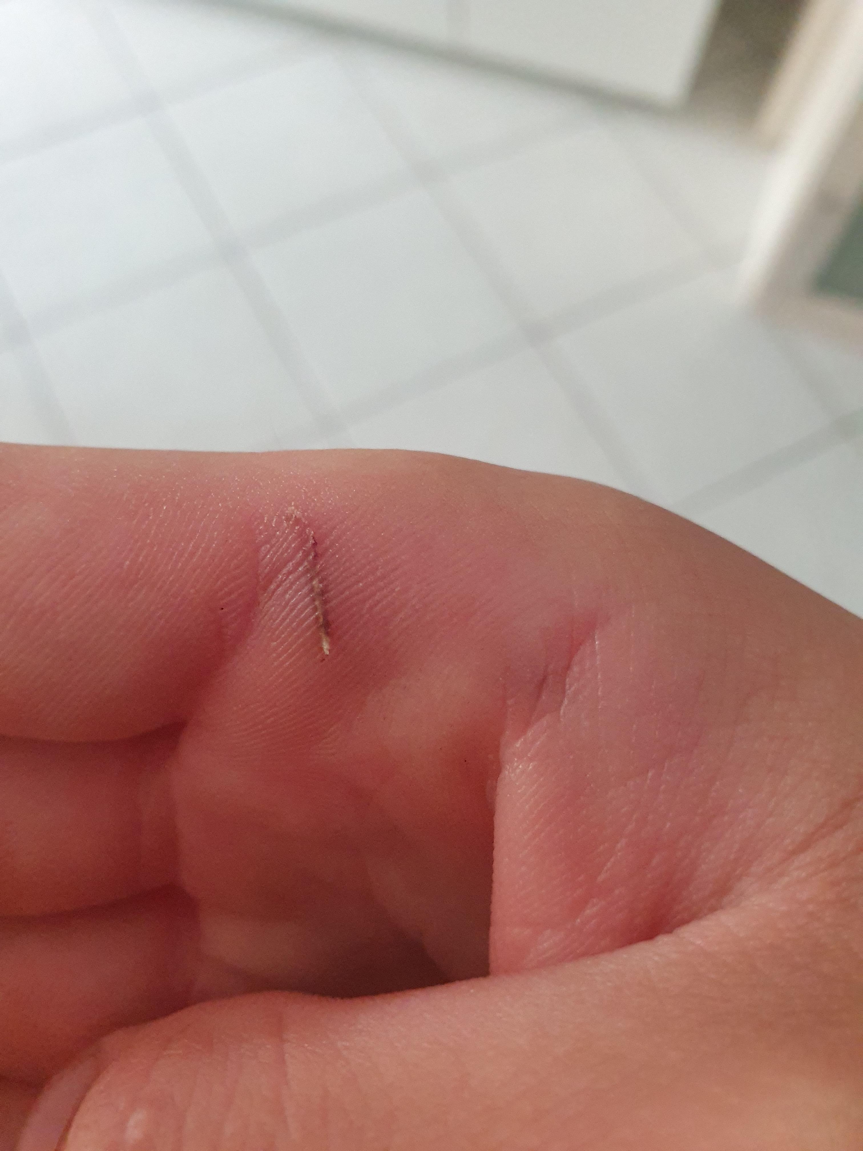 Wie kann ich den Splitter entfernen? (Hand)