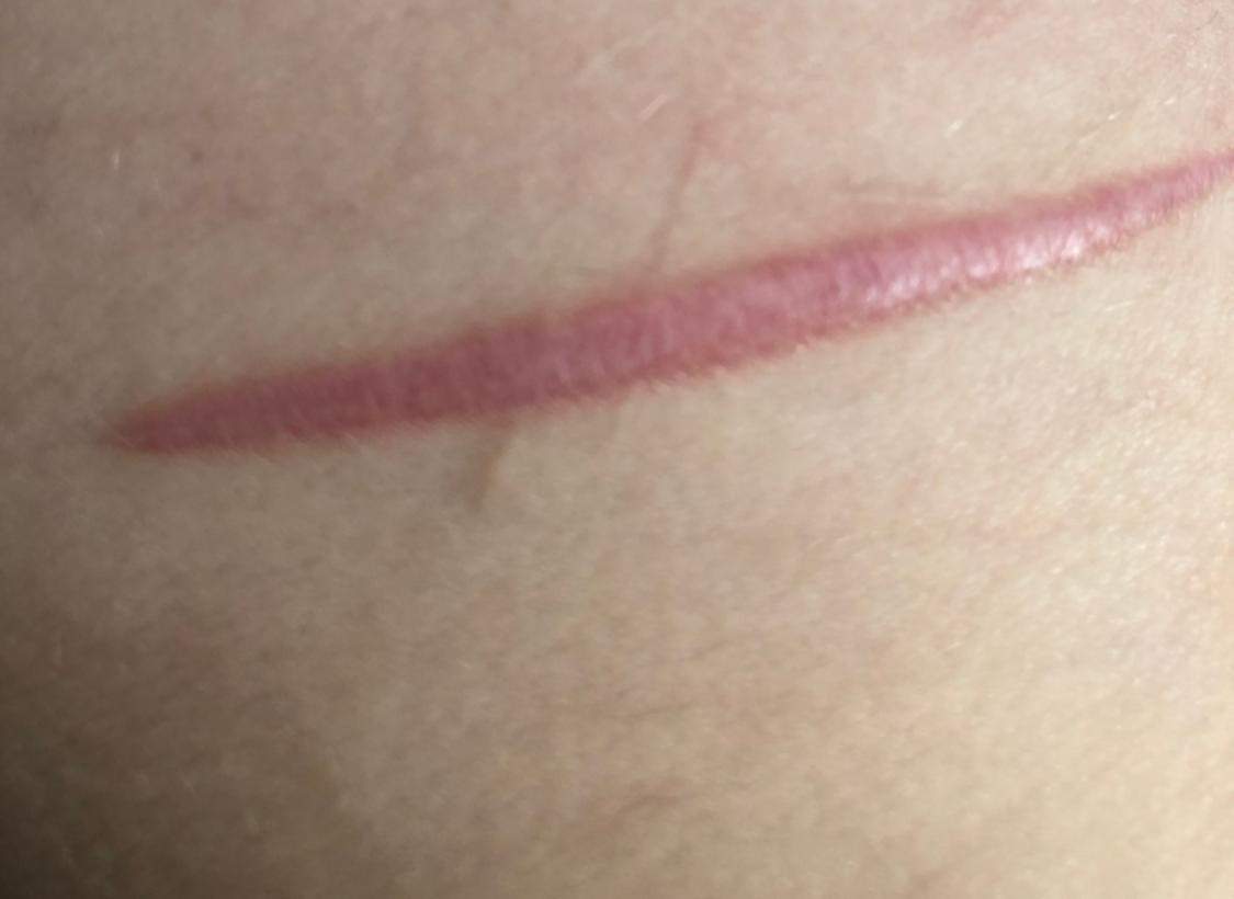 Wie lange dauert es bis diese Narbe abheilt? TRIGGERWARNUNG ...