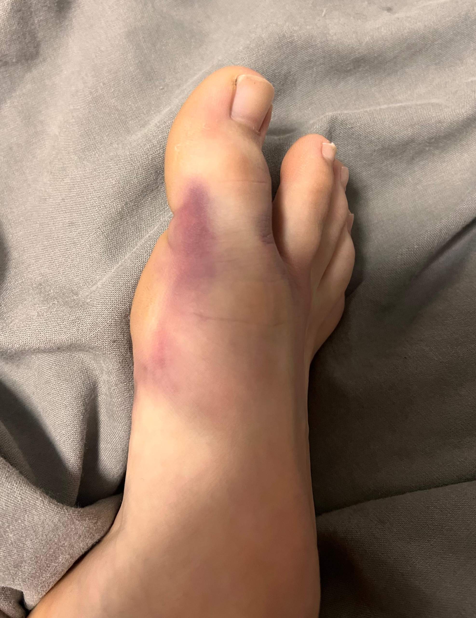 Wie schlimm ist das? (Gesundheit und Medizin, Fußschmerzen, blauer Fleck)