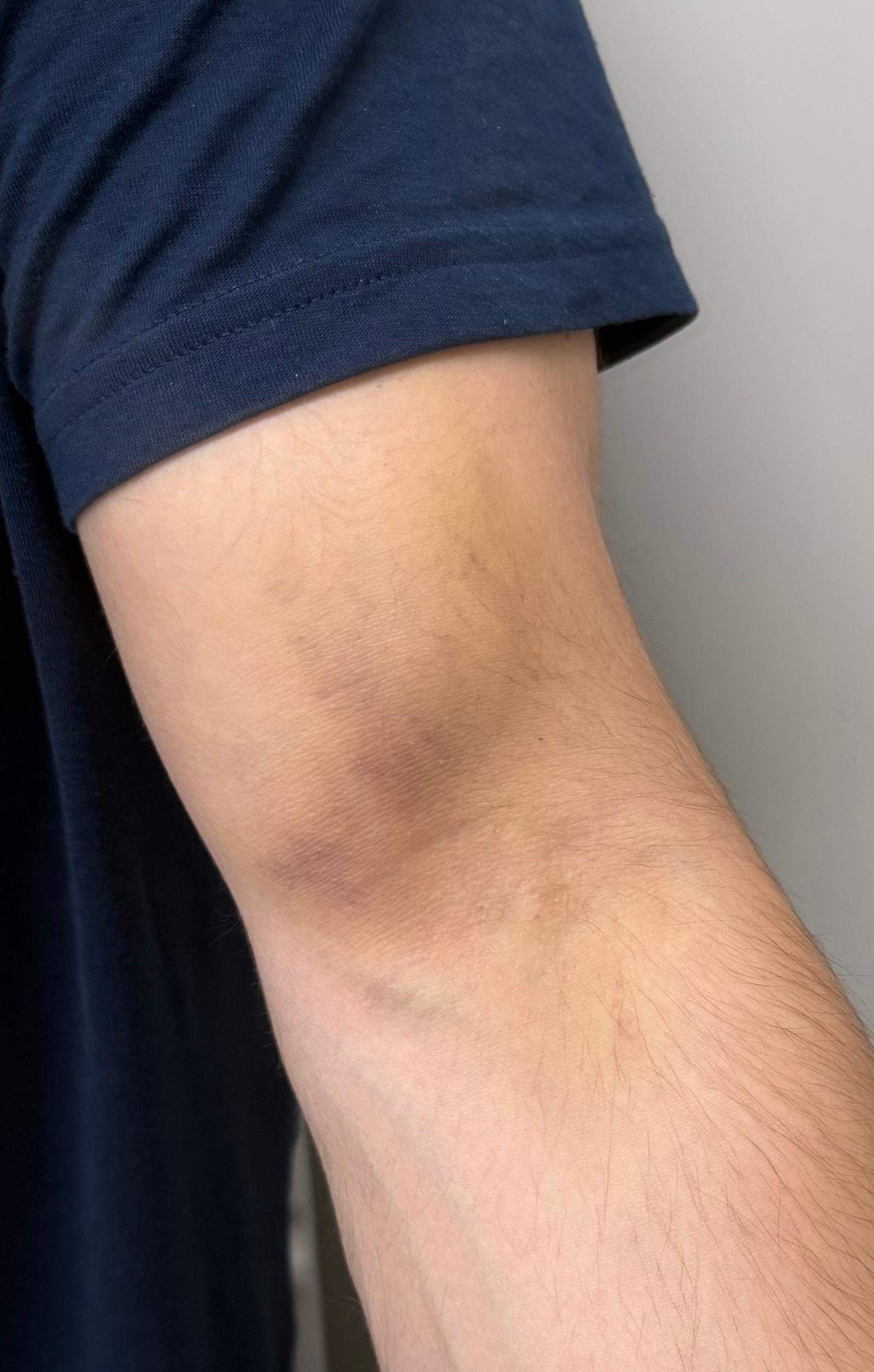 Wie schlimm sieht das aus? (Fitness, Krafttraining, Gym)