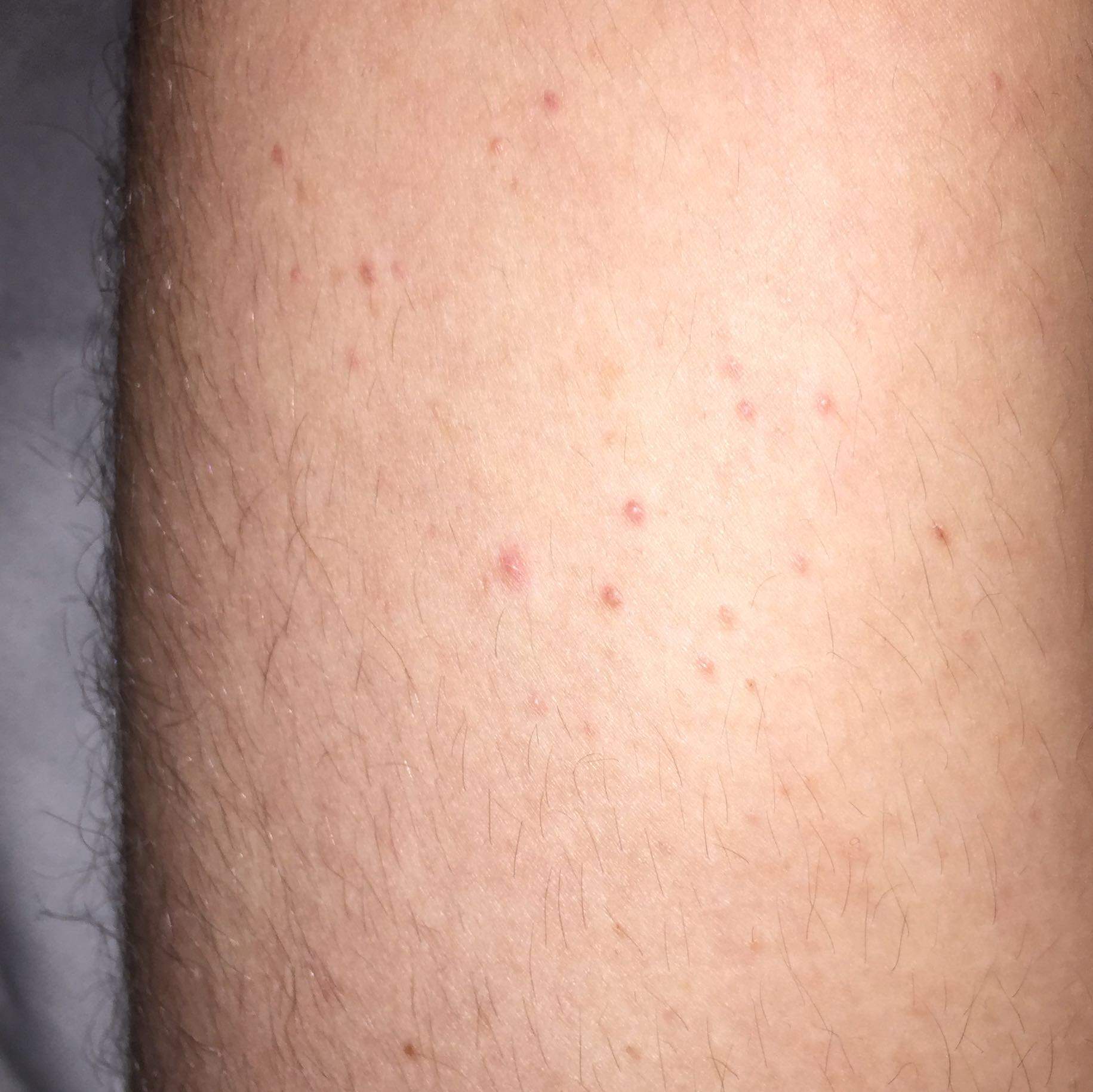 Wie werd ich diese Pickel los? (Gesundheit, Haut, Rötung)