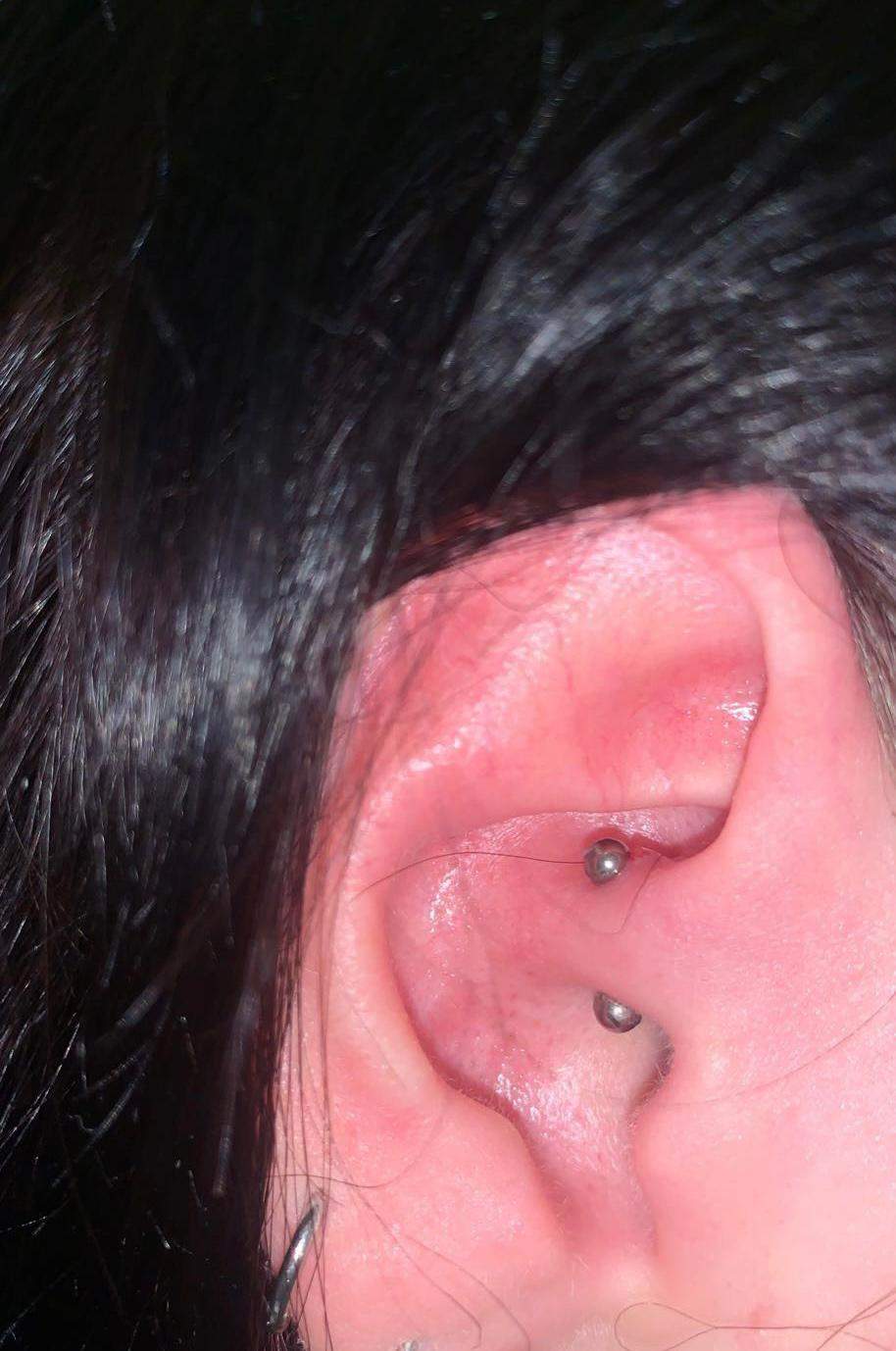 Wildfleisch am Daith? (Piercing, Entzündung, Ohrknorpelpiercing)