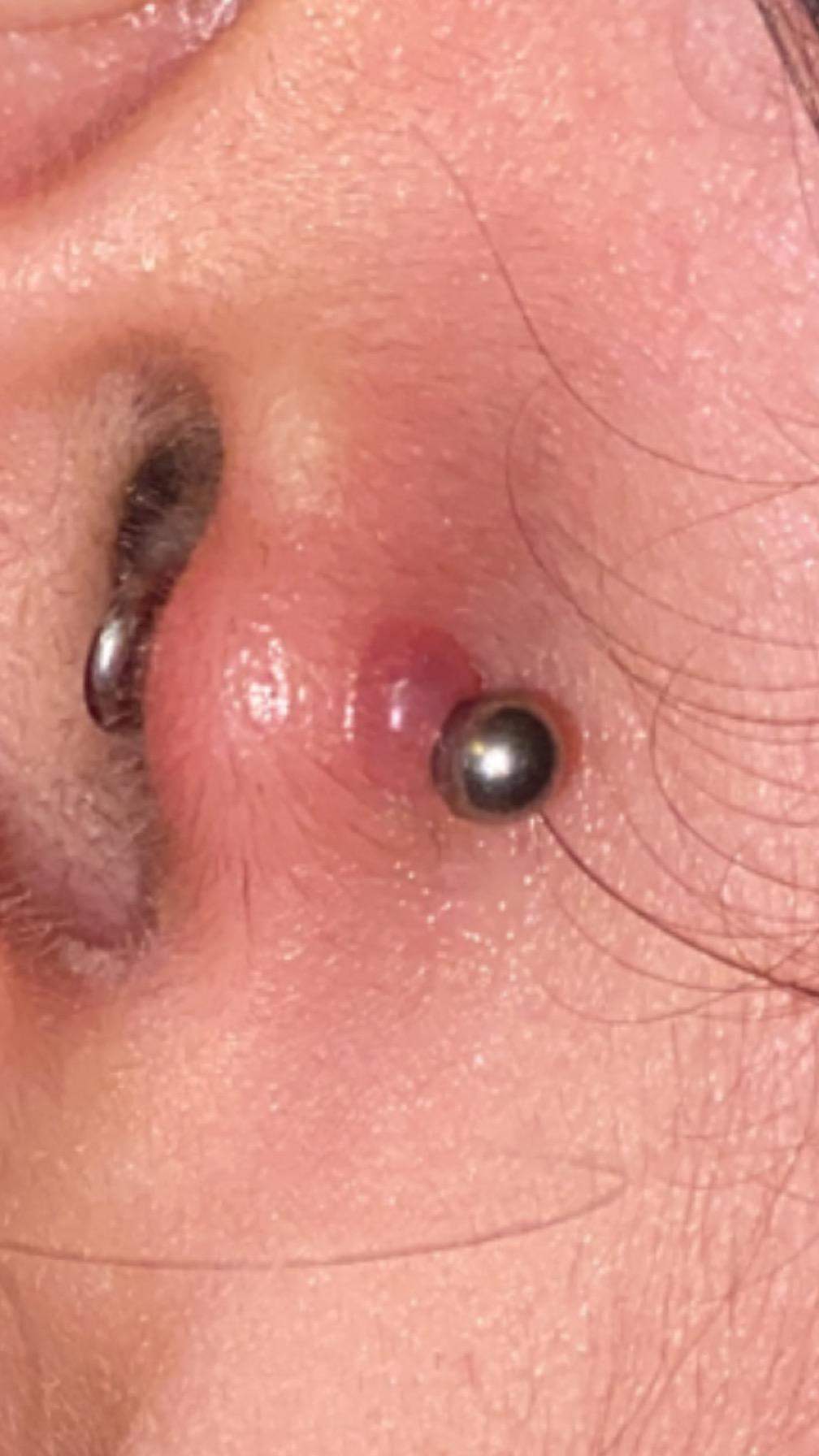 Wildfleisch am Tragus was tun? (Piercing, Entzündung, Piercingpflege)