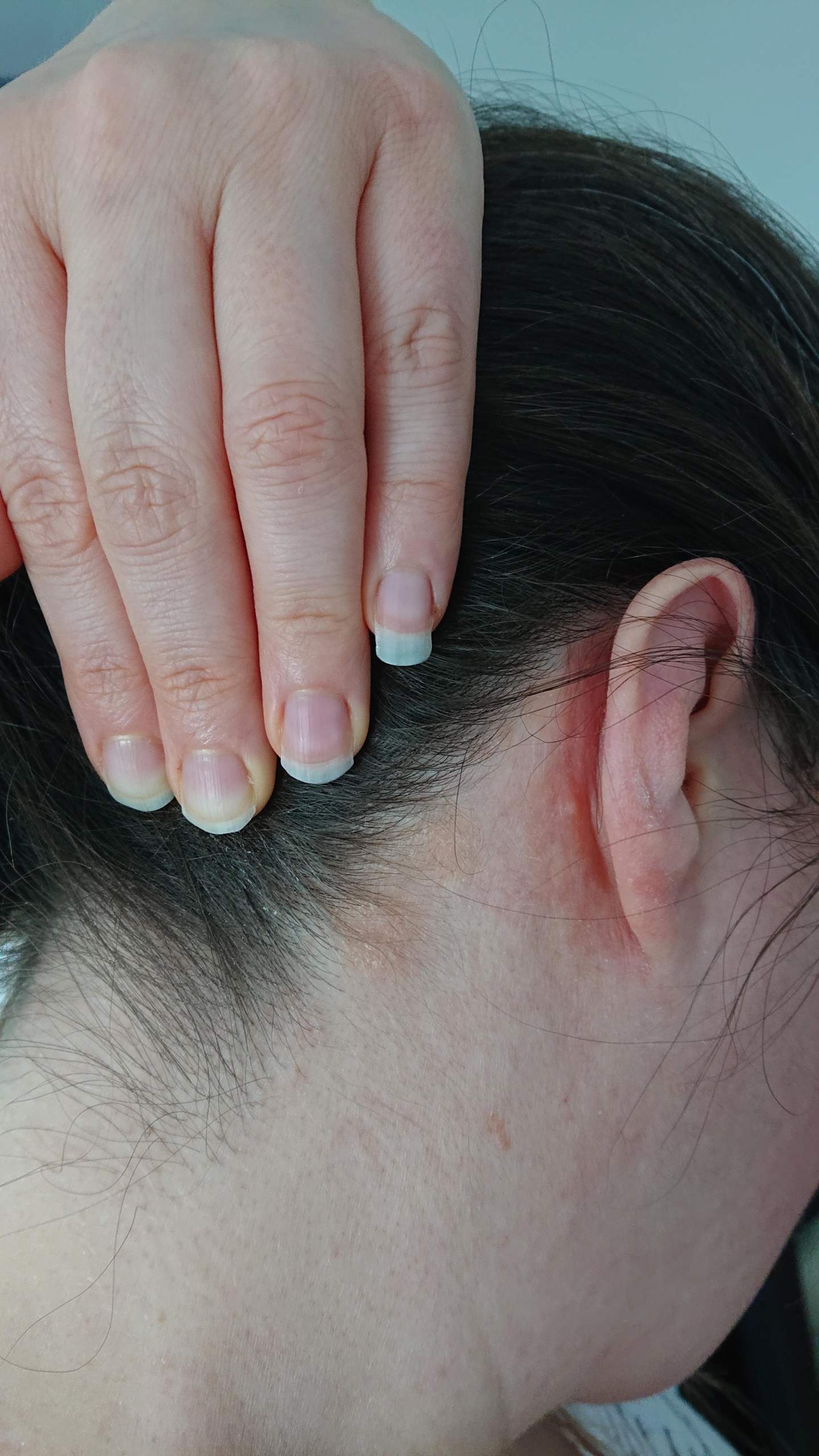 Wirklich eine Pilzinfektion? (Gesundheit und Medizin, Hautkrankheit)