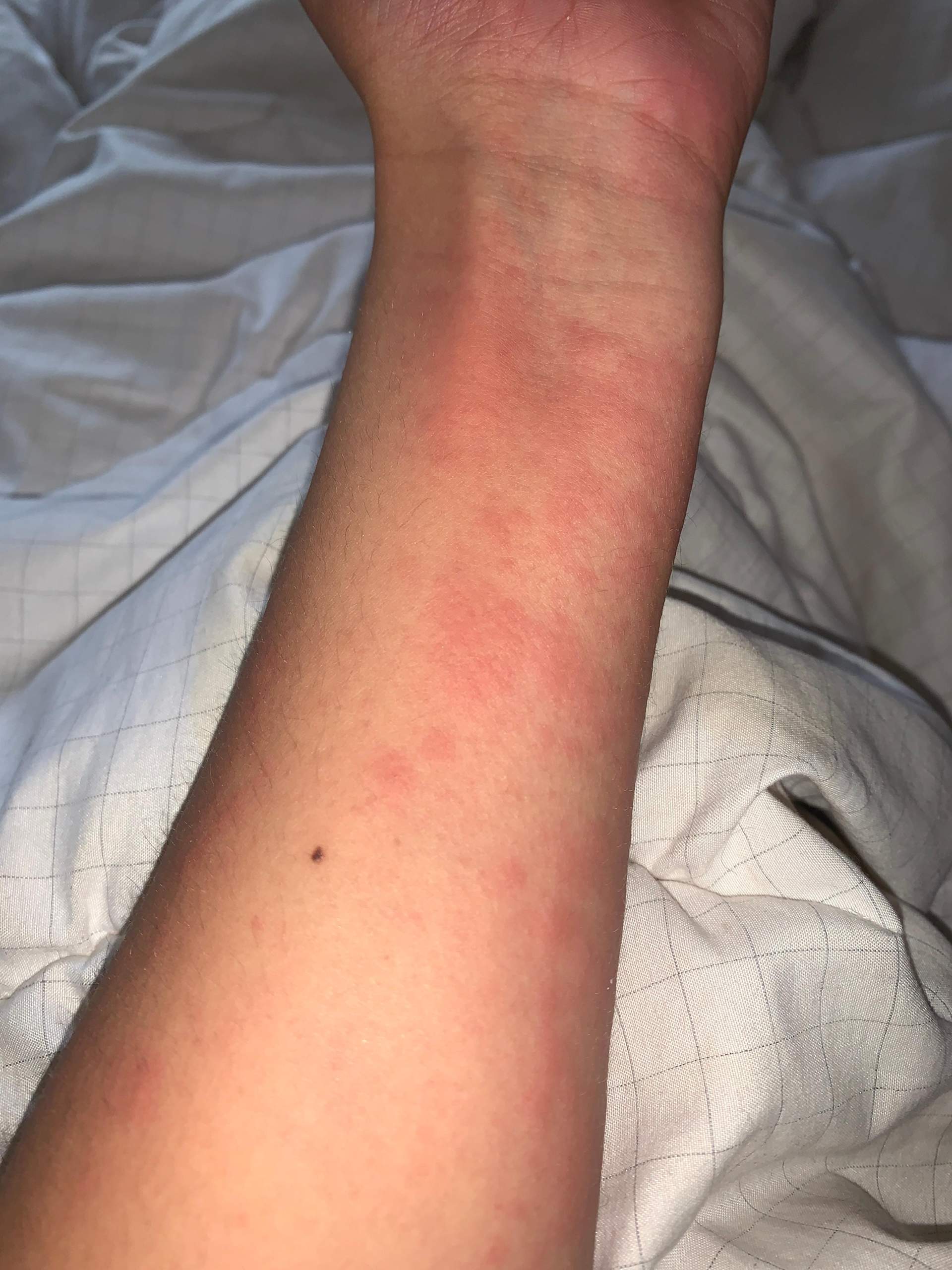 Wisst ihr was das ist? (juckende Haut, Pusteln)