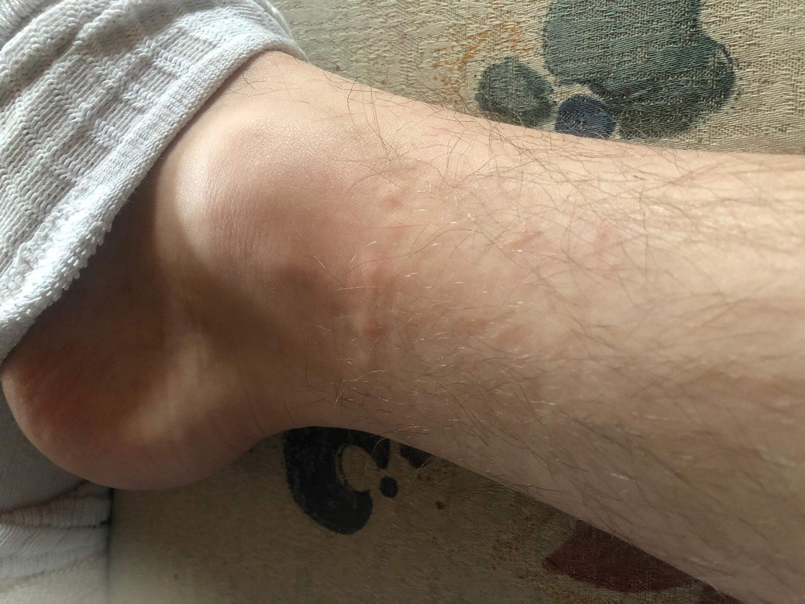 Woher kommen diese Quaddeln? (Gesundheit und Medizin, Gesundheit, Medizin)