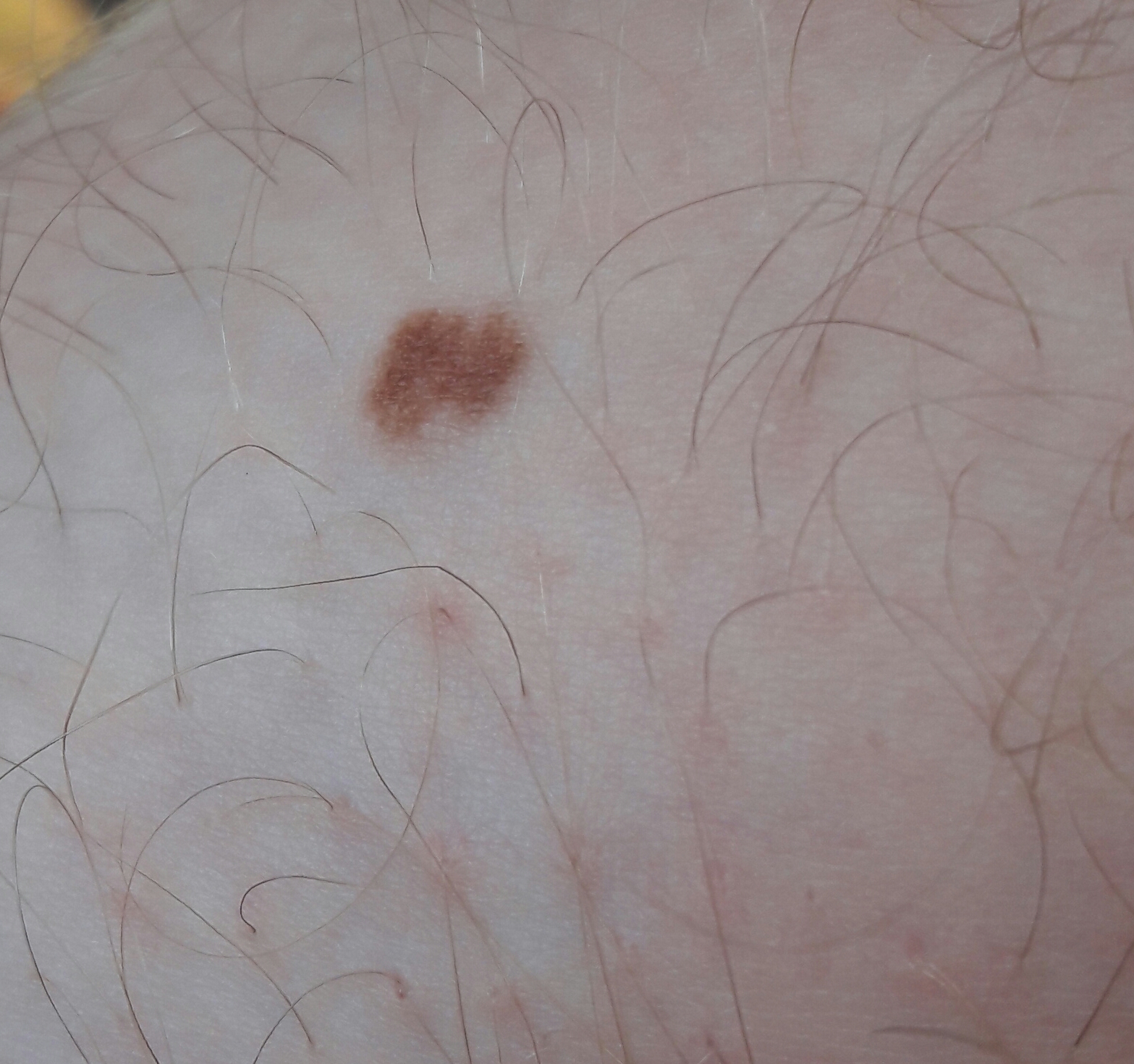 Würdet ihr euch bei dem Muttermal Sorgen machen? (Gesundheit, Haut ...