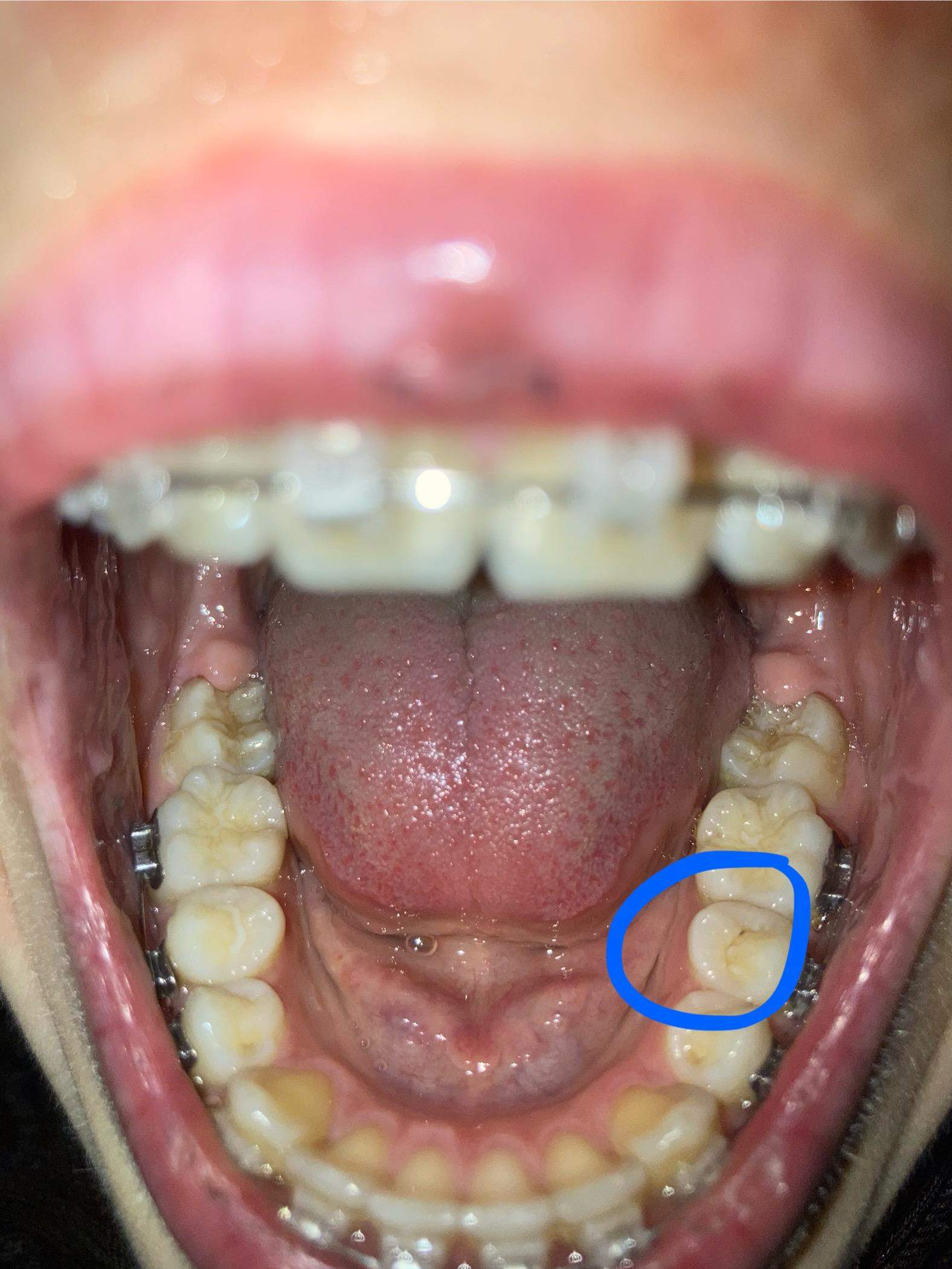 Zähne/Karies? (Zahnarzt, Zahnmedizin, Zahnstein)
