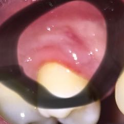 Zahn Abszess? (Gesundheit und Medizin, Zähne)