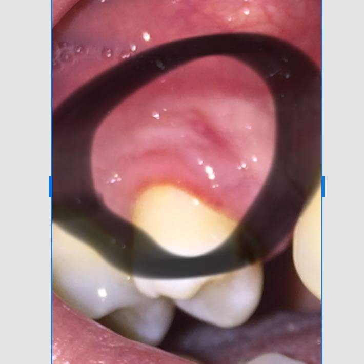 Zahn Abszess? (Gesundheit und Medizin, Zähne)