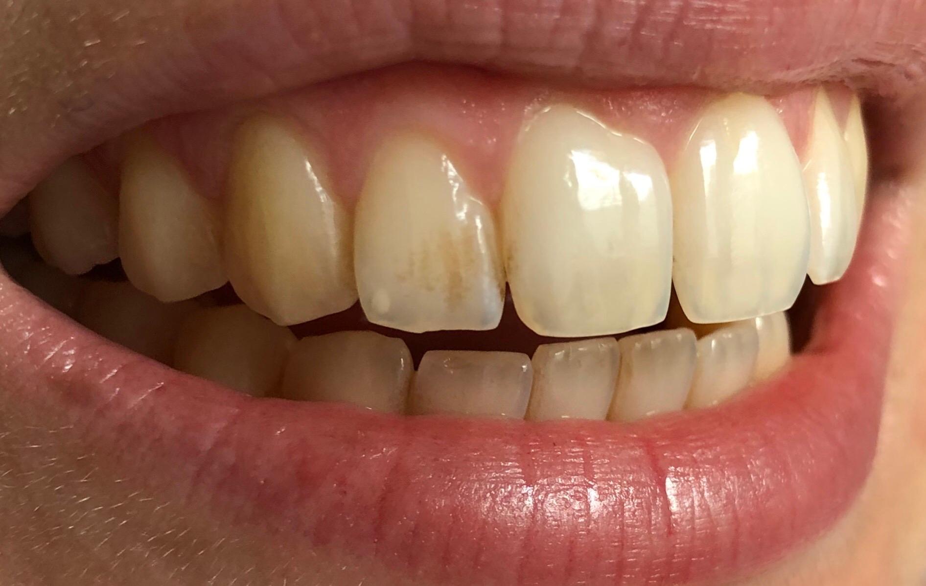 Zahn gelb / braun verfärbt (wie zerkratzt) Zahnschmelz/Karies? (Zähne ...