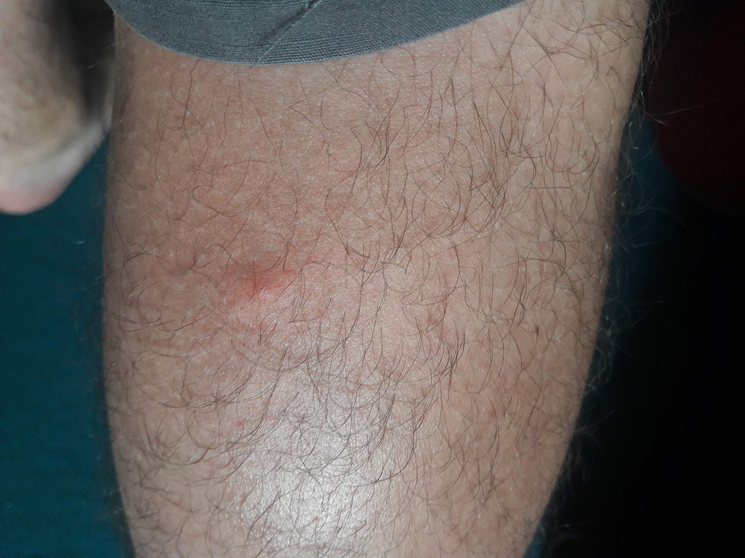 Zeckenbiss juckt bisschen und ist leicht rot - zum Arzt? (Gesundheit ...