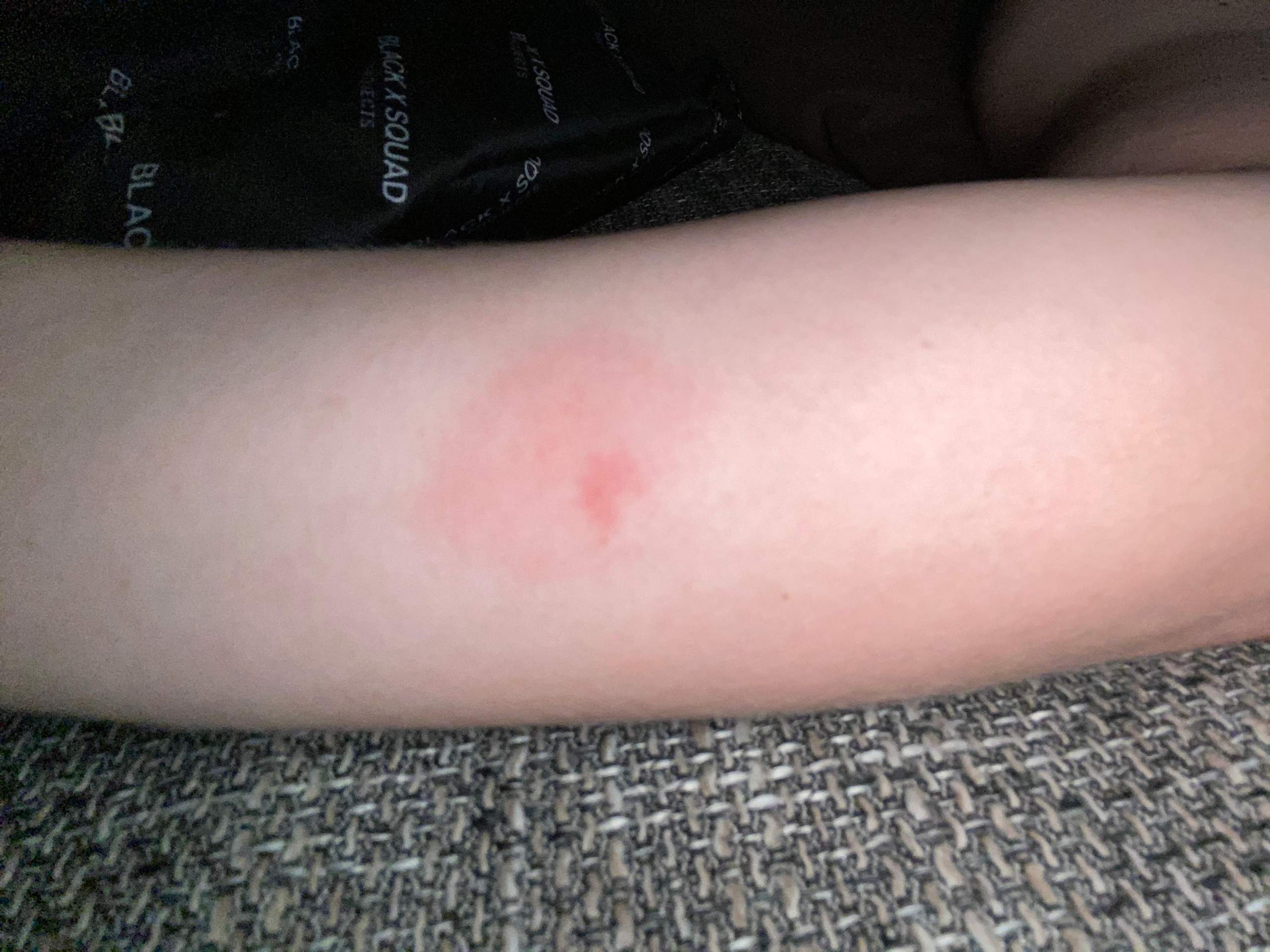 Zeckenbiss? Mückenstich?