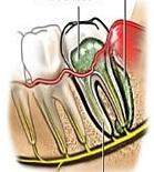 Zyste am Letzen zahn oberer Kiefer? (Gesundheit, Zähne, Zahnarztbehandlung)